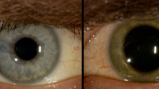 Ebola virus found lurking in eye of survivor, Dr. Ian Crozier - CBS News
