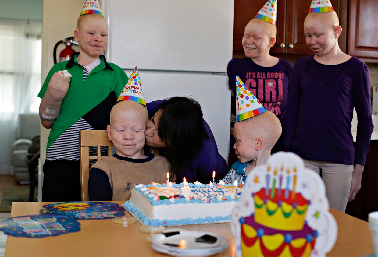 New limbs, new hope for Africa's hunted albino children