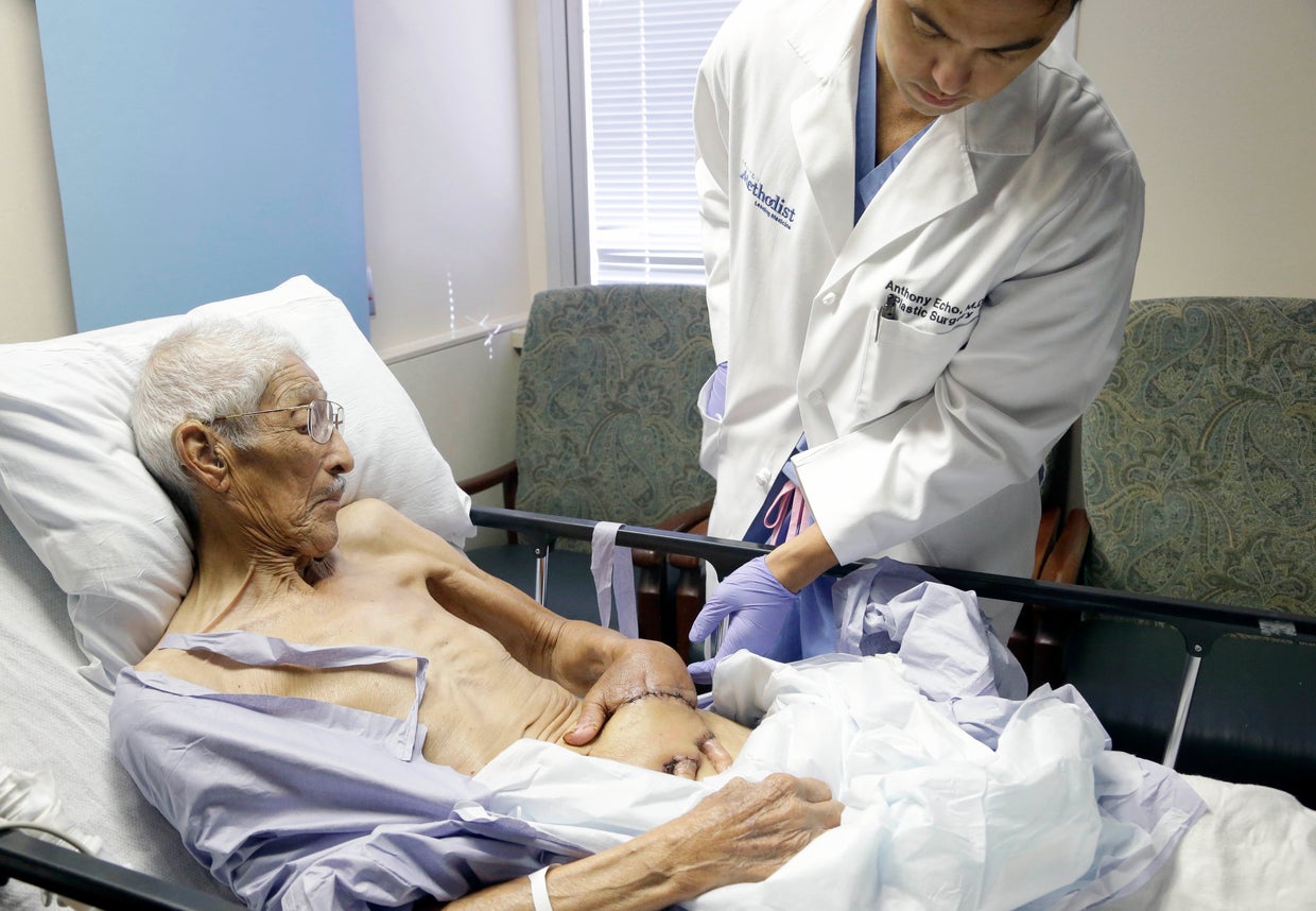 Doctors save man's hand by tucking it into his tummy - CBS News