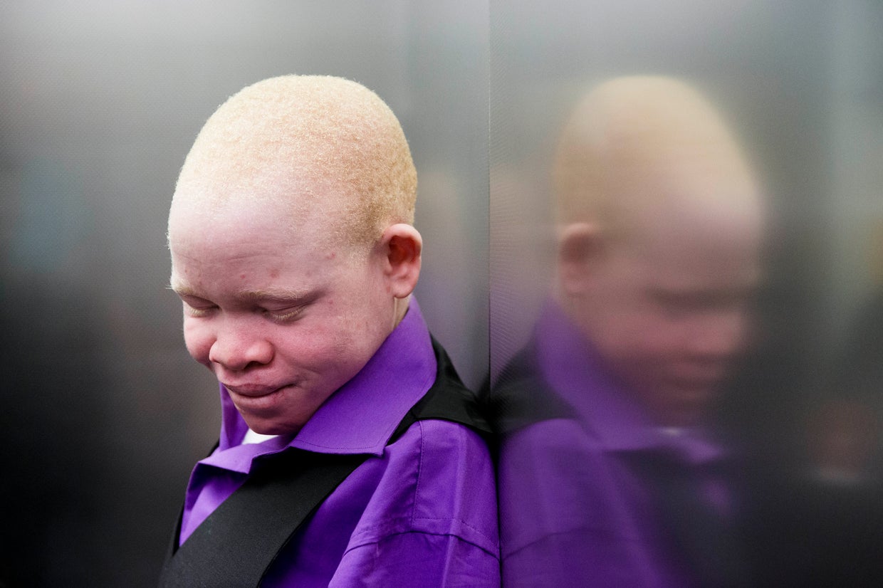 New limbs, new hope for Africa's hunted albino children