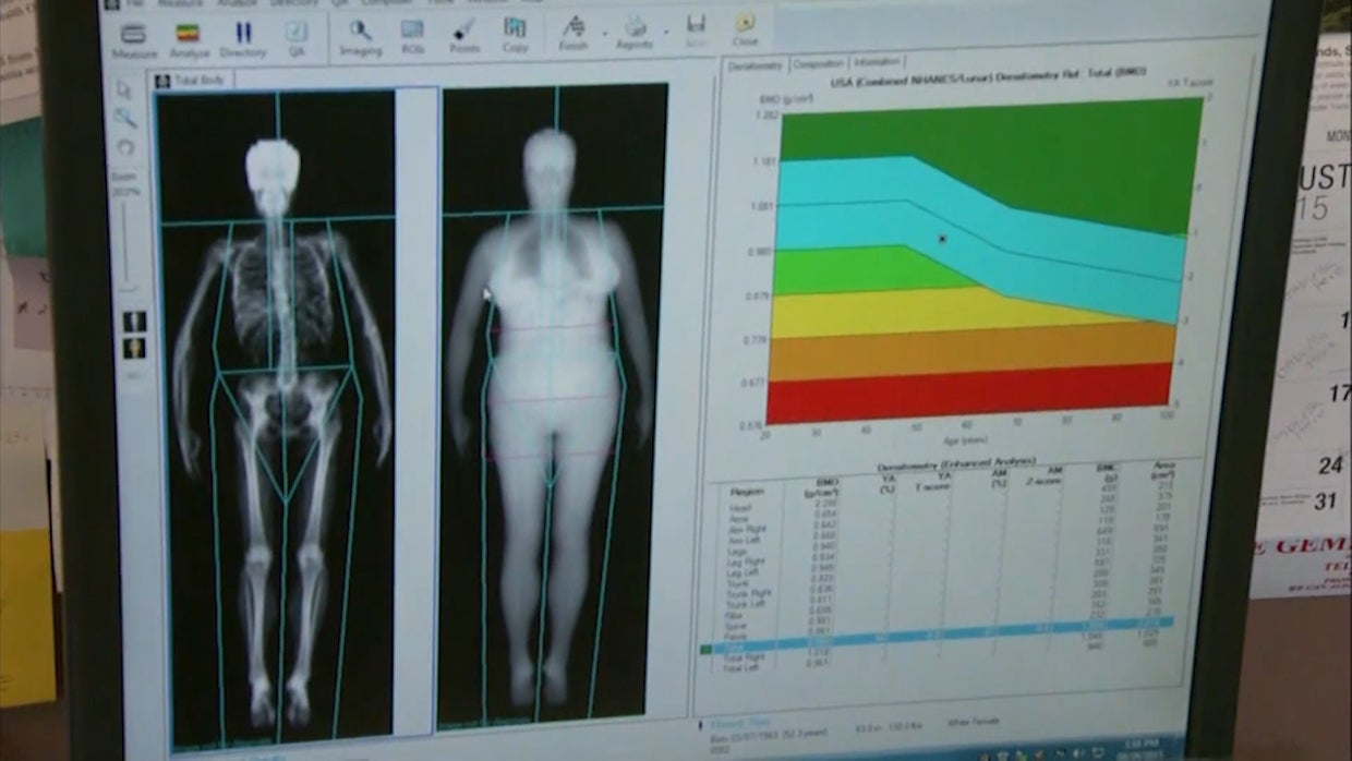 Fat scanner may give better picture of health - CBS News