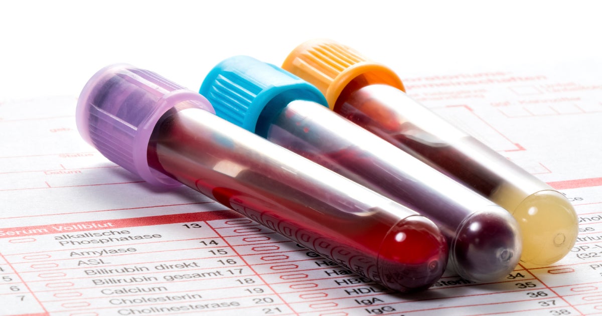 One blood test might be enough to diagnose diabetes, study says - CBS News