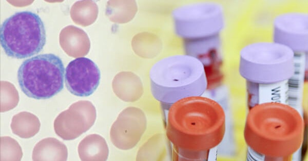 Leukemia drug study halted after more patient deaths - CBS News