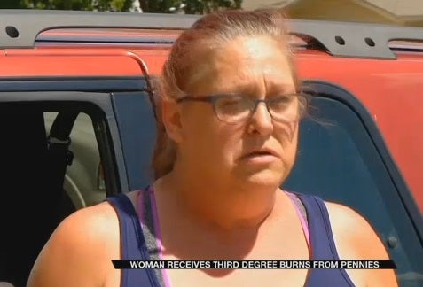Okla Woman Suffers 3rd Degree Burns From Pennies Left In Hot Car Cbs