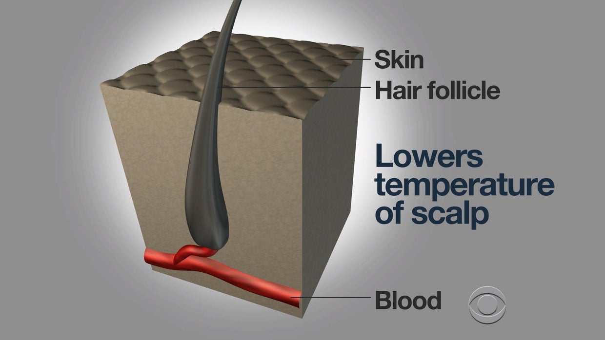 Studies reveal effectiveness of cooling caps in fighting chemo-induced ...