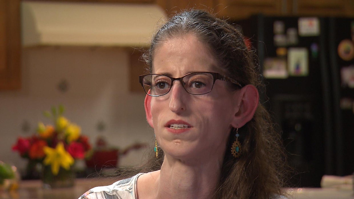 Woman's rare genetic disorder could hold the key to weight loss - CBS News
