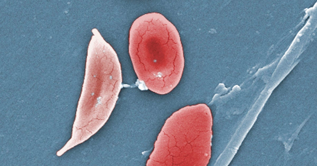 Sickle cell drug Endari wins FDA approval; first new drug in 20 years ...