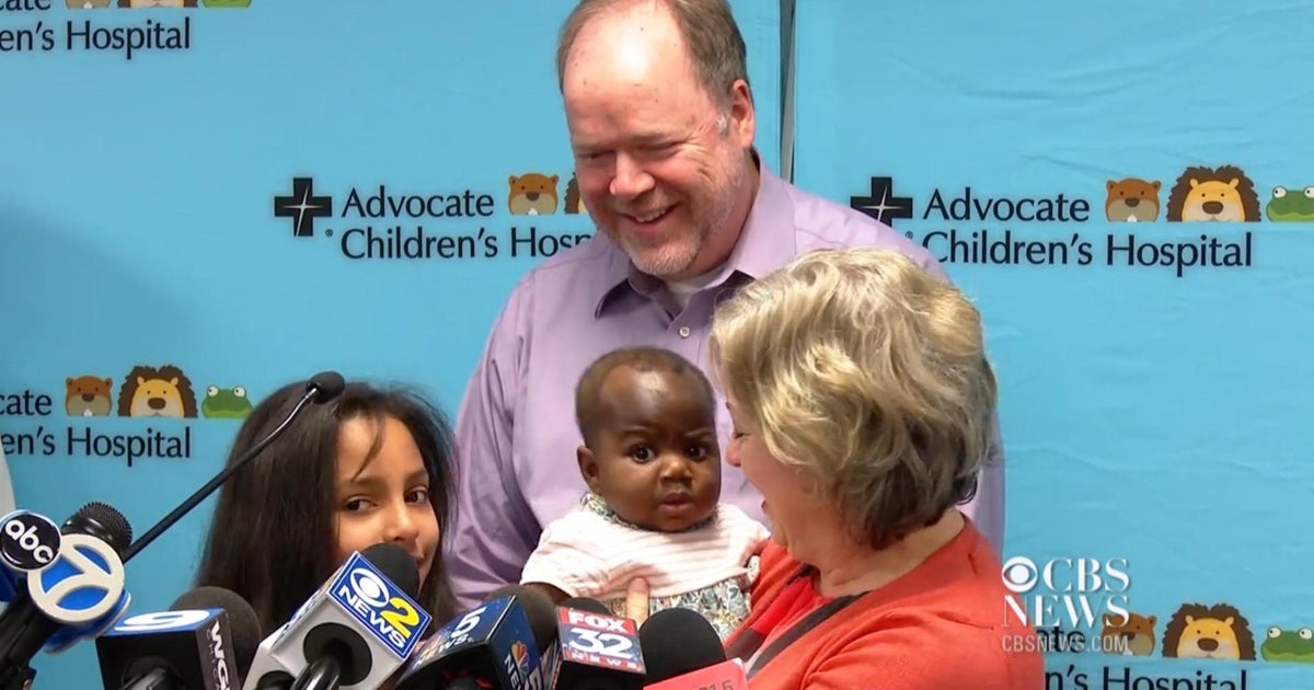 Baby born with extra legs undergoes successful surgery in Illinois ...