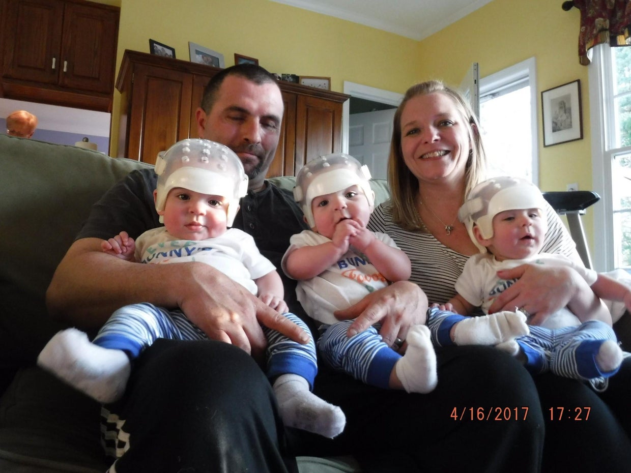 Doctors repair skulls of triplets born with rare condition - CBS News