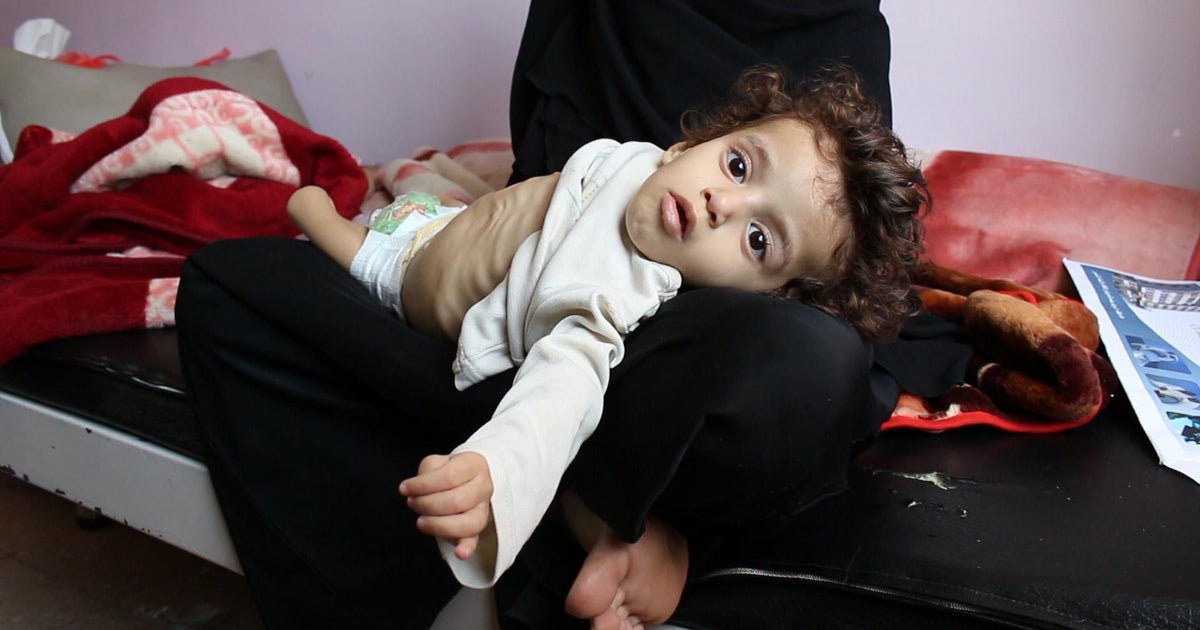 How Yemen's civil war is starving its children - CBS News