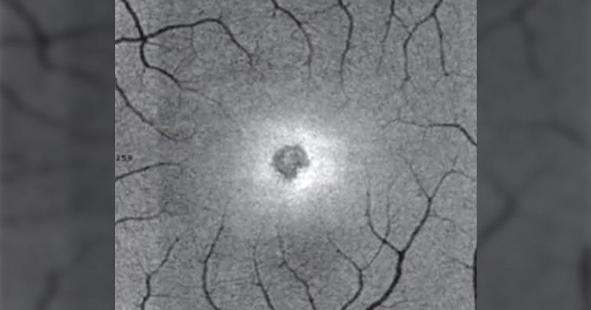 Solar eclipse damage to woman's eye revealed in striking images - CBS News