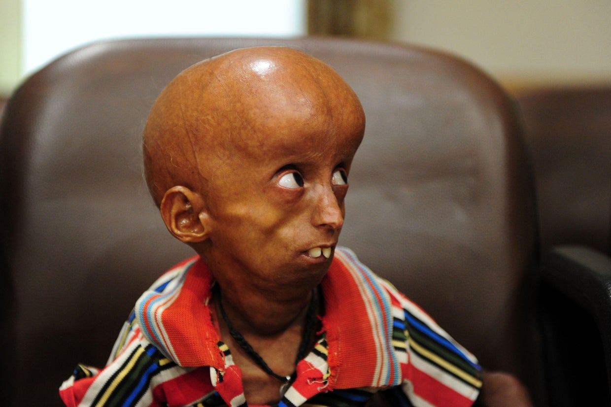 Progeria study: Kids with rare rapid-aging disease get hope from ...