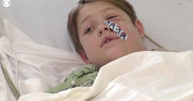 Boy impaled in the face with skewer is miraculously saved - CBS News