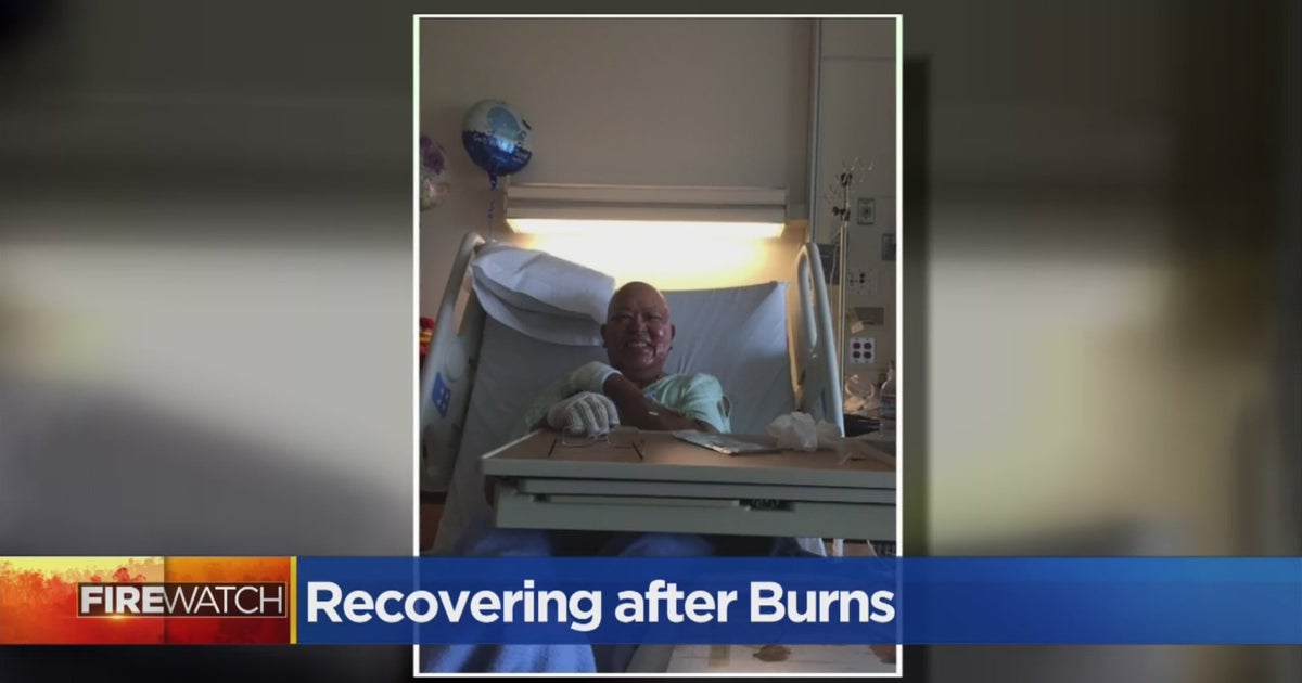 Burn Victims Escape Camp Fire But Have A Long Road To Recovery - CBS ...