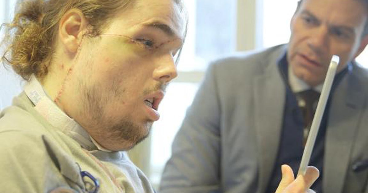 26-Year-Old Face Transplant Patient From Yuba City Reveals New ...