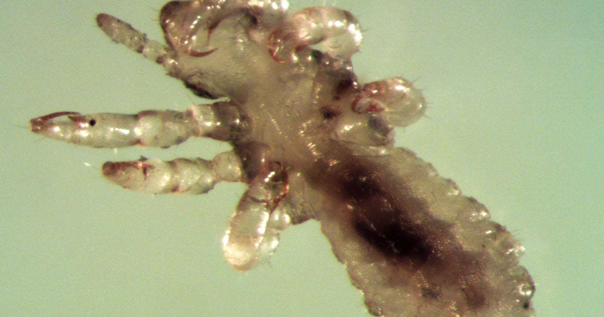 Dallas-Fort Worth Sees 50 Percent Uptick In Head Lice Infestations ...