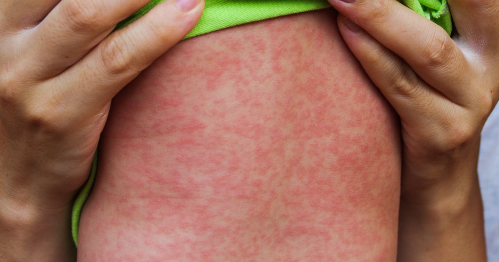34 Confirmed Cases of Measles in Michigan - CBS Detroit