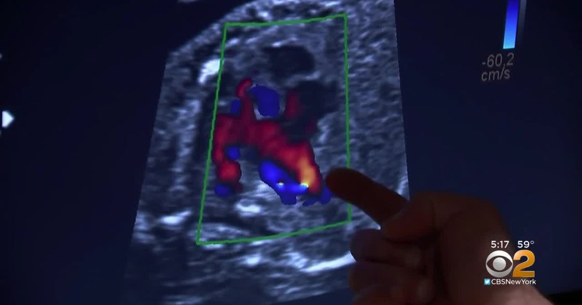 Miracle Baby Amelia Thriving Not Long After Doctors In Philadelphia ...