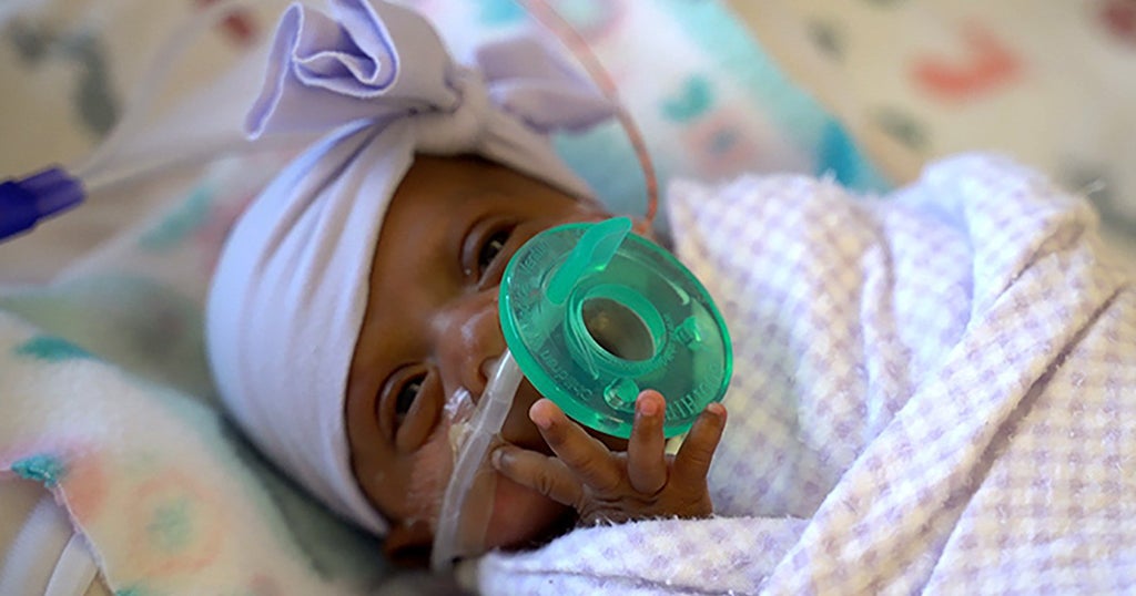 She Was The World's Smallest Baby, Now She's A Healthy Infant - CBS ...
