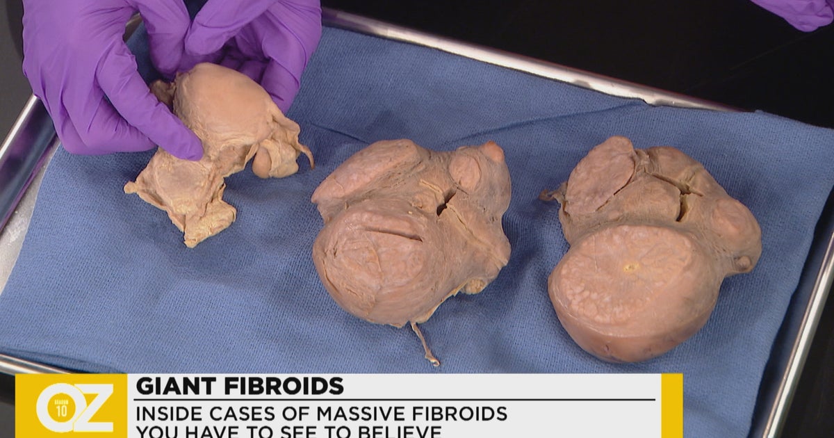Giant Fibroids: Inside Cases Of Massive Fibroids You Have To See To Believe - CBS Detroit