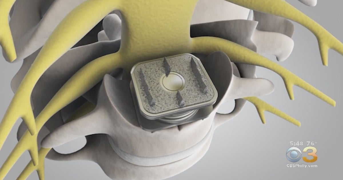 New Artificial Disc Surgery Giving Hope To People With Weakening Spines ...