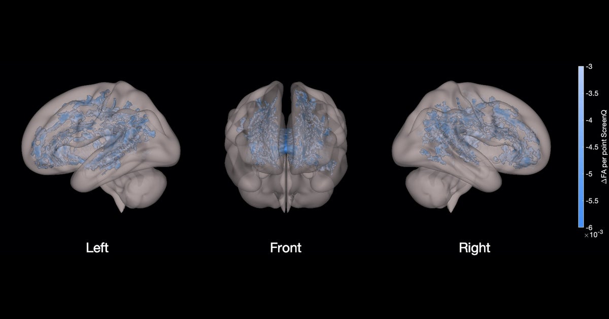 MRIs Show Screen Time Linked To Lower Brain Development In Preschoolers ...