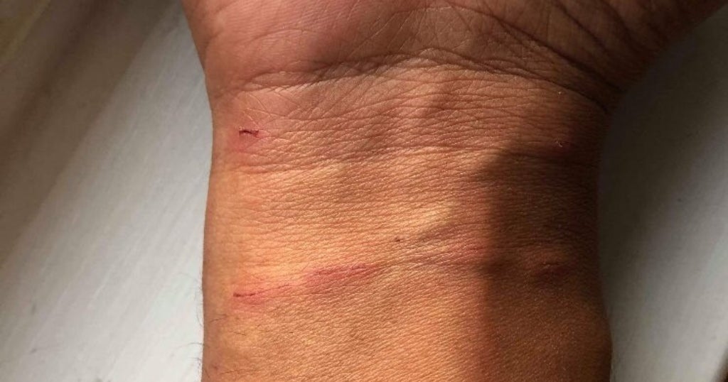 Man Billed $2,300 For Walking Into Emergency Room For Cat Scratch - CBS ...