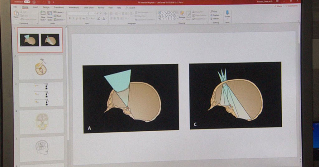 New Mom With Brain Tumor Turns To Boston Hospital For Keyhole Brain ...