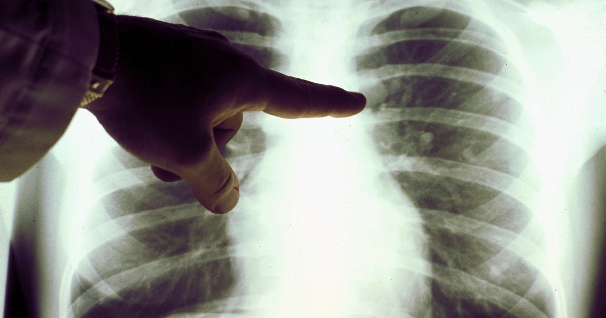 Cancer death rate sees largest-ever single-year drop in U.S. - CBS News