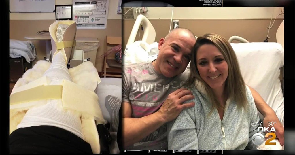 MACI Cartilage Repair Offers Alternative To Knee Replacement - CBS ...