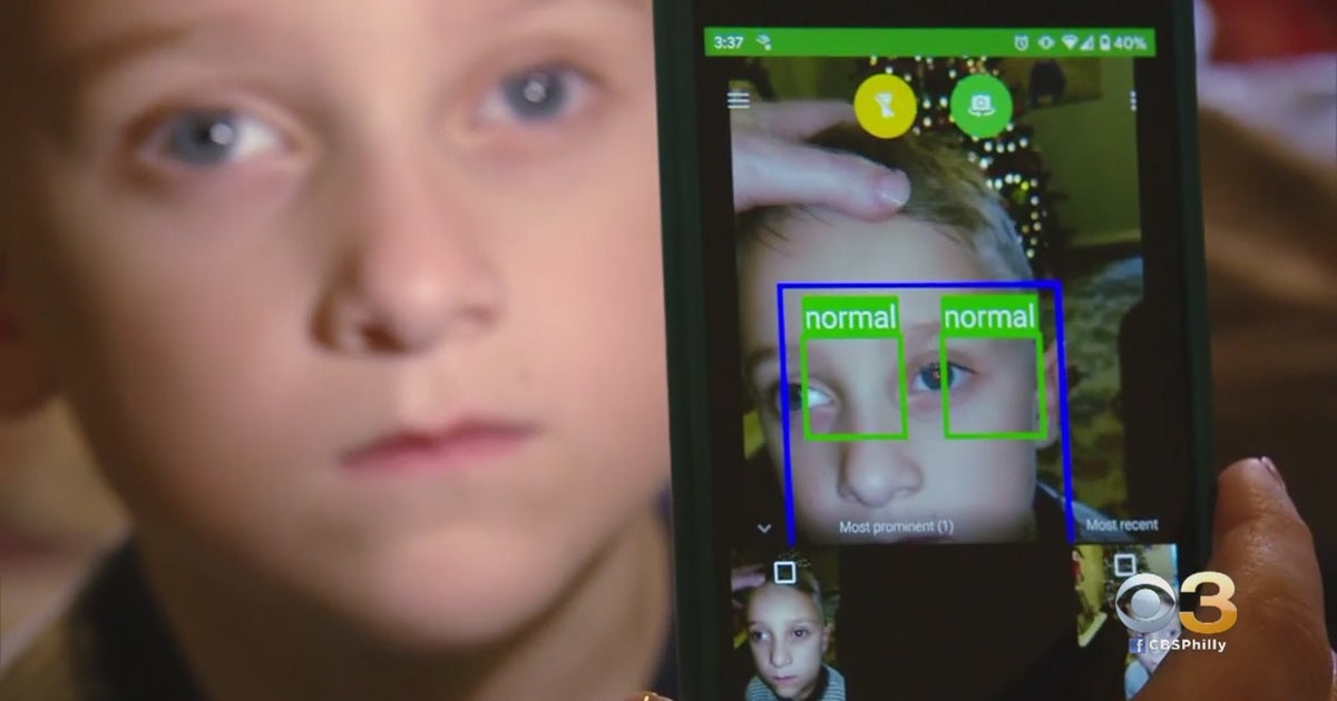 App Helping To Detect Eye Disease By Scanning Photos On Smart Phone To ...