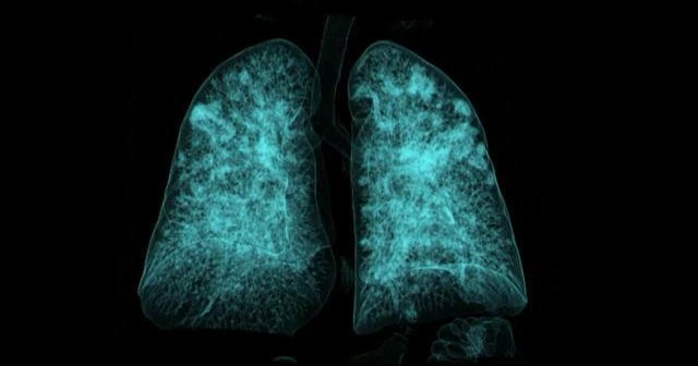 How lung scans can play an important role in detecting coronavirus - CBS News