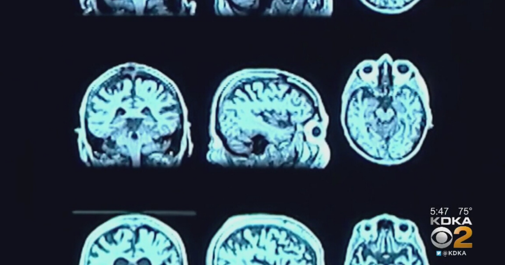 Local Doctors See Neurological Complications For Coronavirus Patients ...