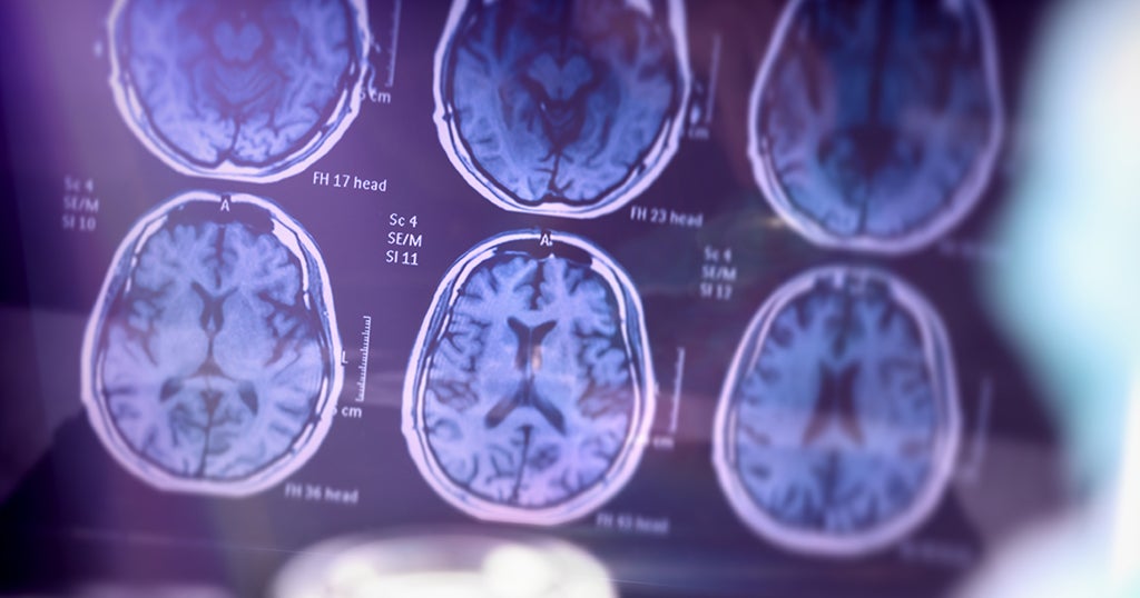 New England Living: Dr. Rudolph Tanzi Discusses Dramatic Breakthroughs ...