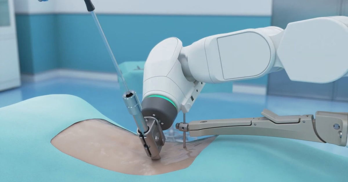 Teenager Is Pain Free Thanks To Robot-Assisted Spine Surgery - CBS Colorado