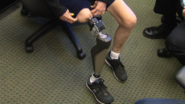 A giant step forward for users of artificial legs - CBS News