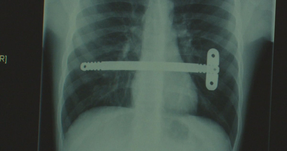 Girl Has Steel Bar Behind Sternum To Reshape Her Sunken Chest - CBS ...