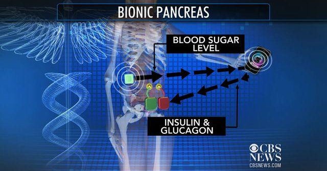 "Bionic" Pancreas helps manage type 1 diabetes - CBS News