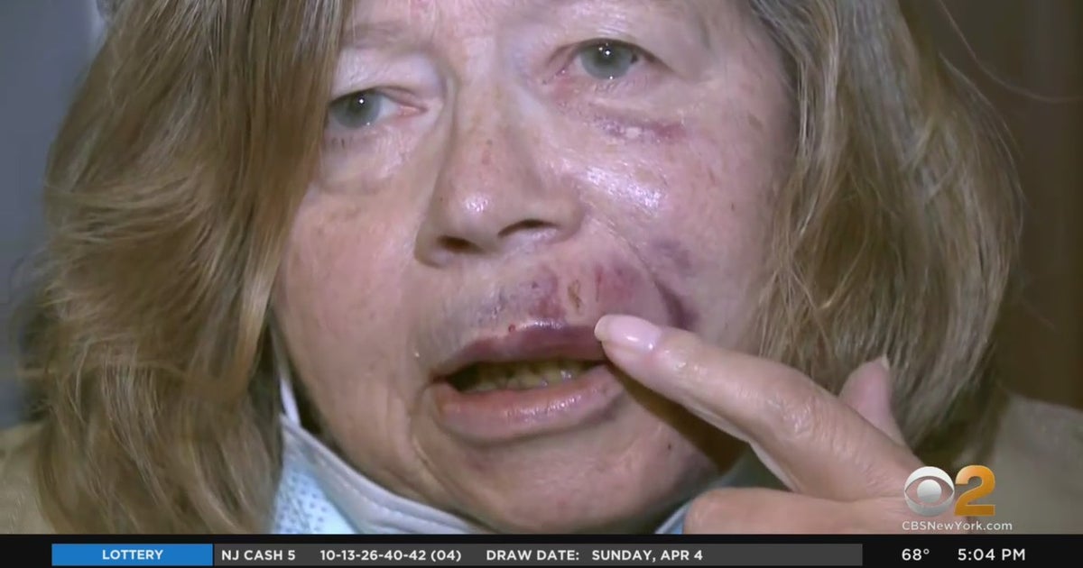 Judith Thomas, 75, Speaks Out After Random Sucker Punch Attack: 'It ...