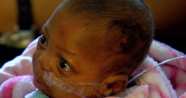 One of the world’s smallest surviving babies goes home - CBS News