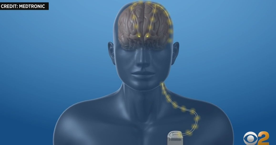 A Pacemaker For The Brain? New Treatment Offers Promising Hope For ...