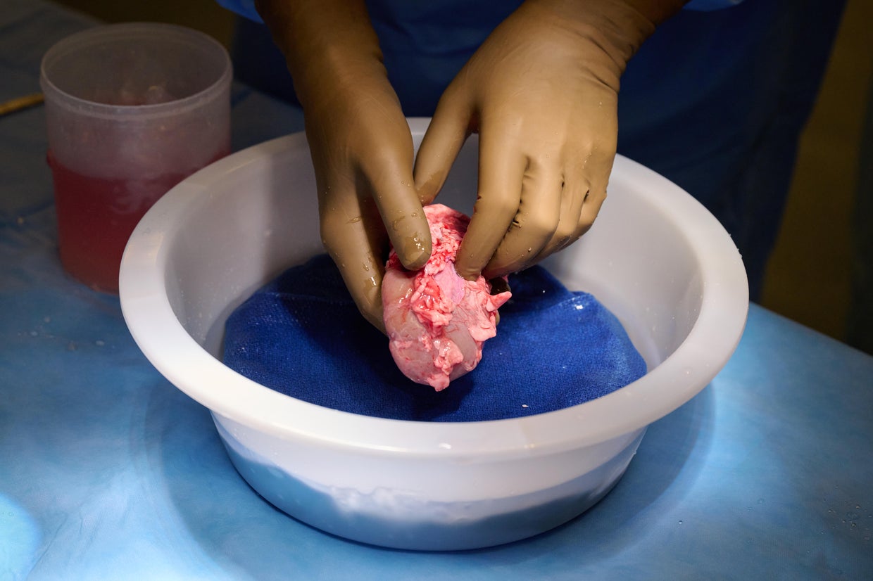 A pig kidney transplant has worked in a human patient for the first ...