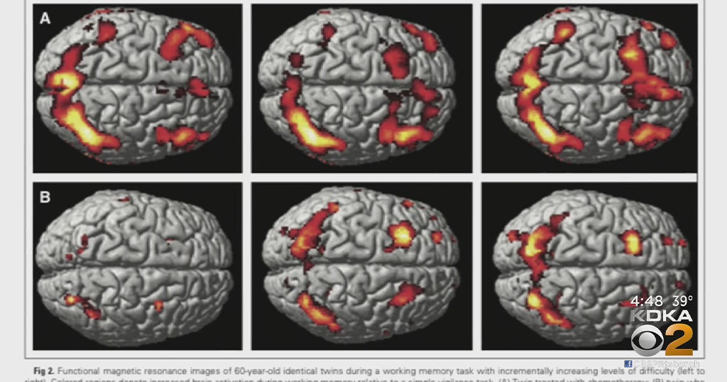 Clinical Trial Looking To Improve Lives Of People With 'Chemo Brain ...