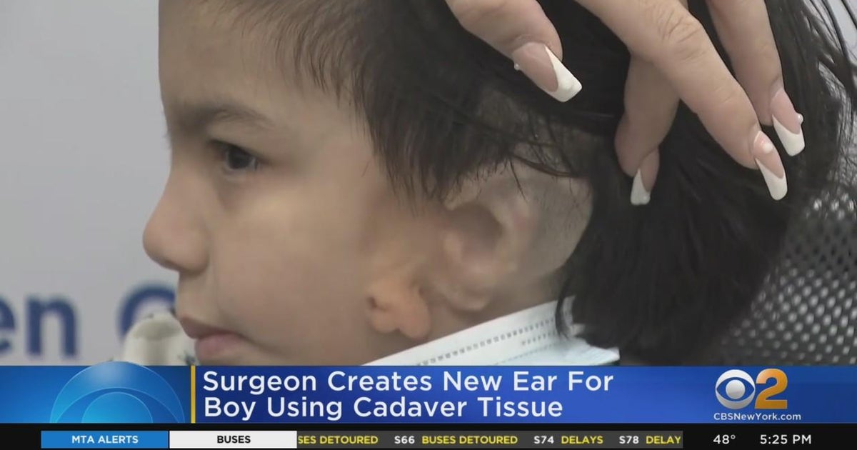 Surgeon creates new ear for boy using cadaver tissue - CBS New York