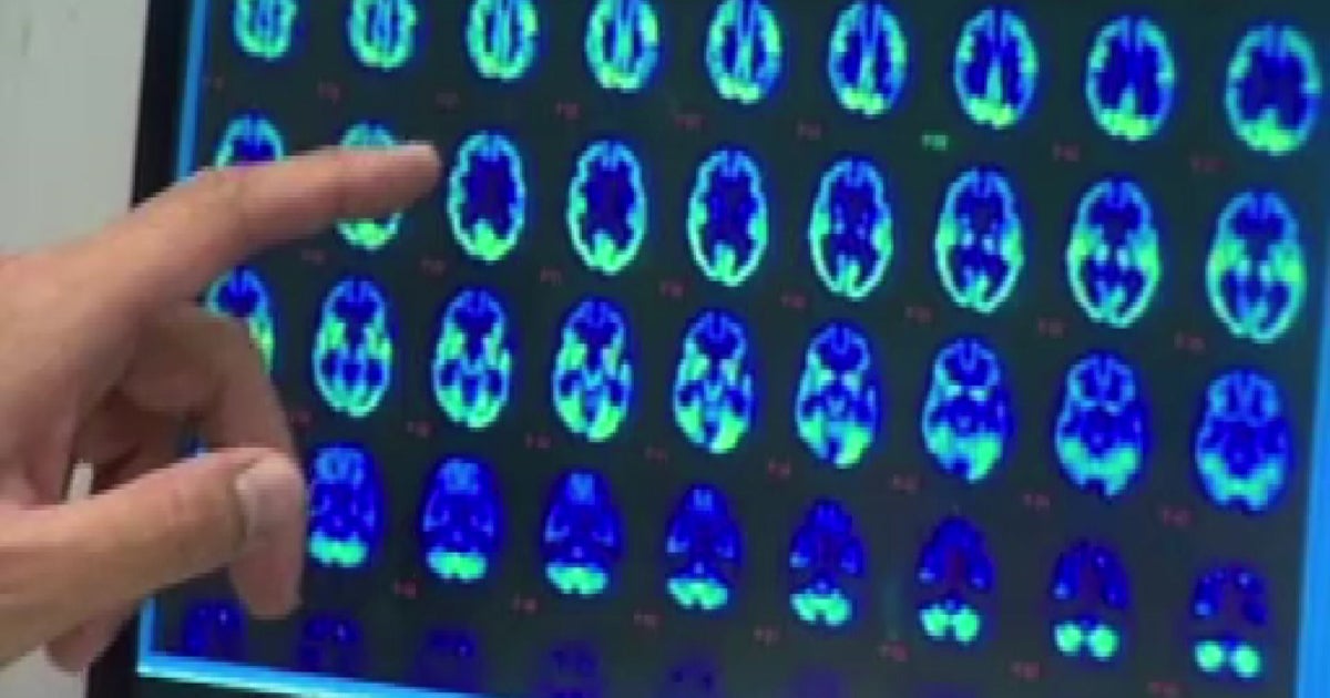 'A Game Changer:' Minnesota Legislature Passes $25M For ALS Research ...