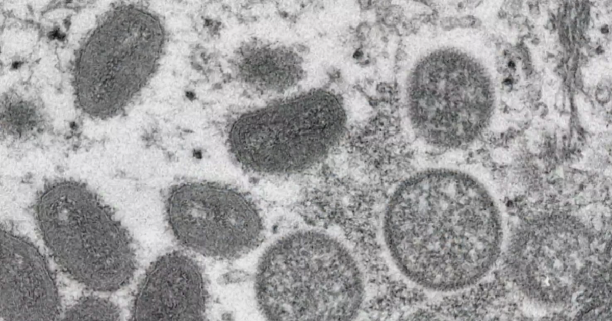 What is monkeypox and should you worry? - CBS Texas