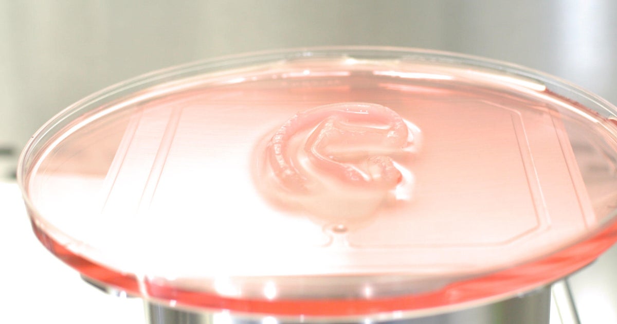 Woman gets 3D printed ear transplant made of her own cells - CBS News