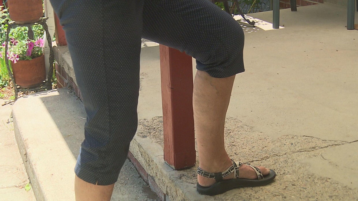 The new frontier in knee replacement has arrived in Colorado - CBS Colorado