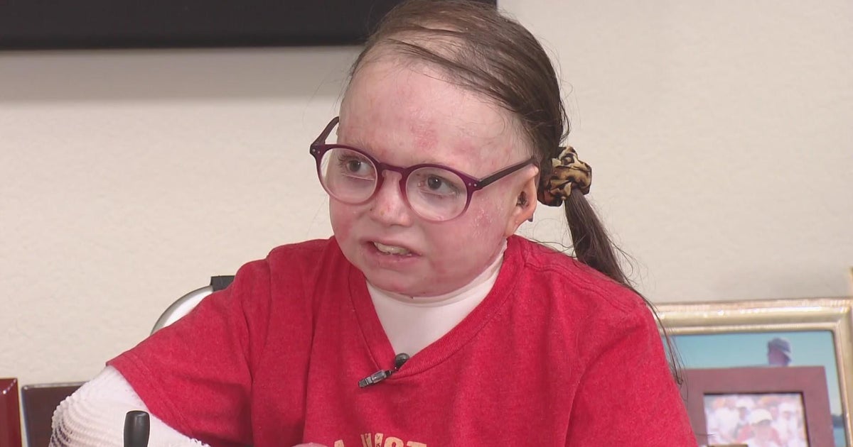 A Special Girl Named Rafi Kopelan Shares Her Story Of Living With A ...