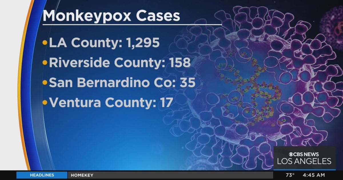 Orange County reports first monkeypox case in a child - CBS Los Angeles
